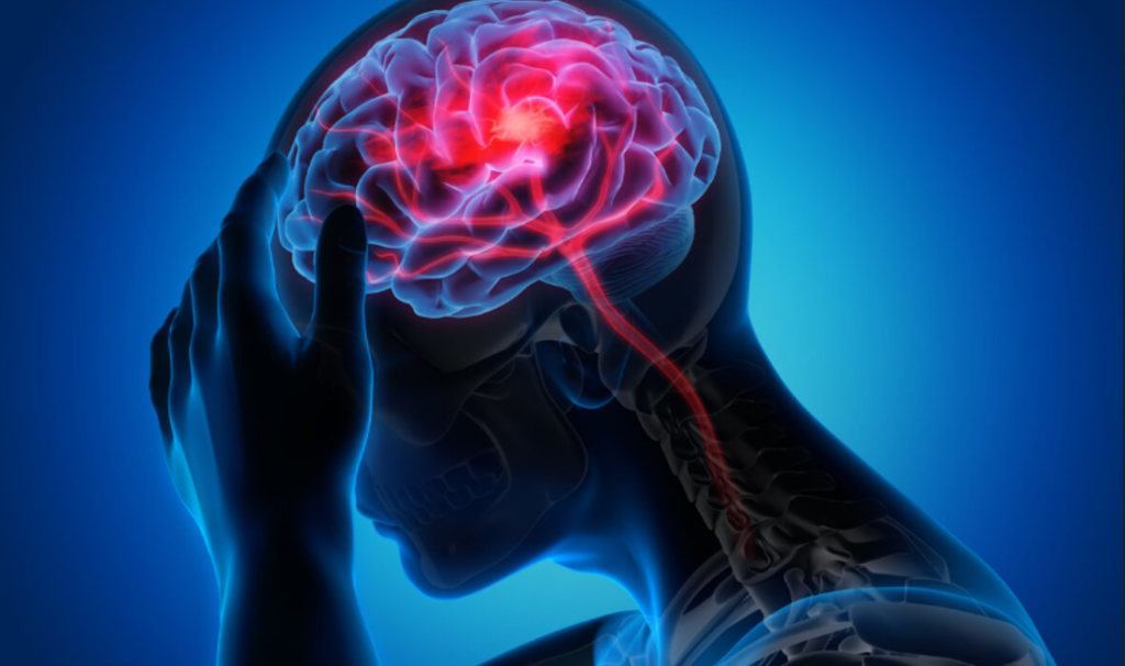 7 Early Warning Signs of Brain Attack That Appear Almost One Month ...